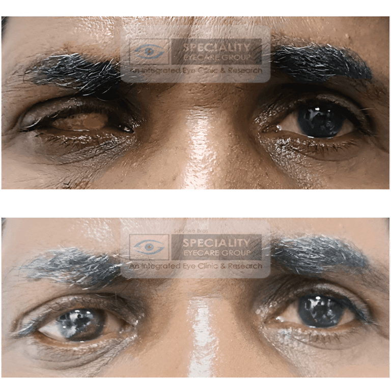 Custom Made Artificial Eye – Speciality Eyecare Group